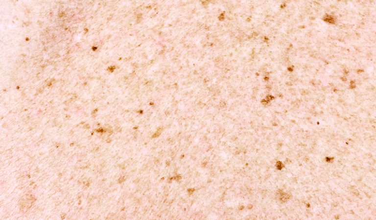 Freckles and Pigmentation - Nu.Reflections: Medical Aesthetics